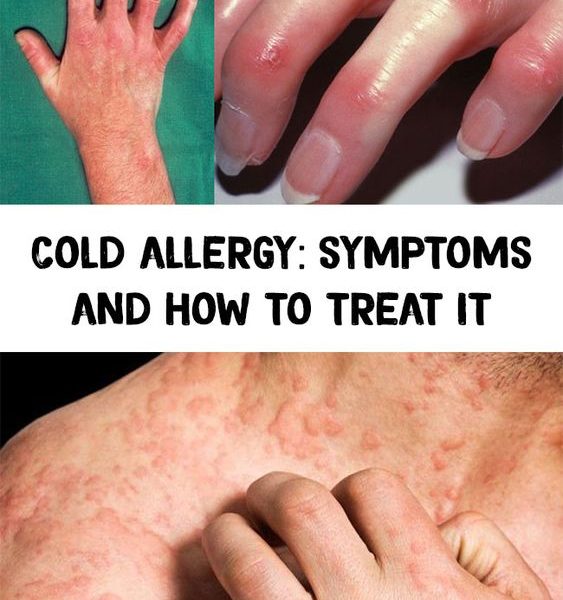 Cold allergy: symptoms and how to treat it – My WordPress Website